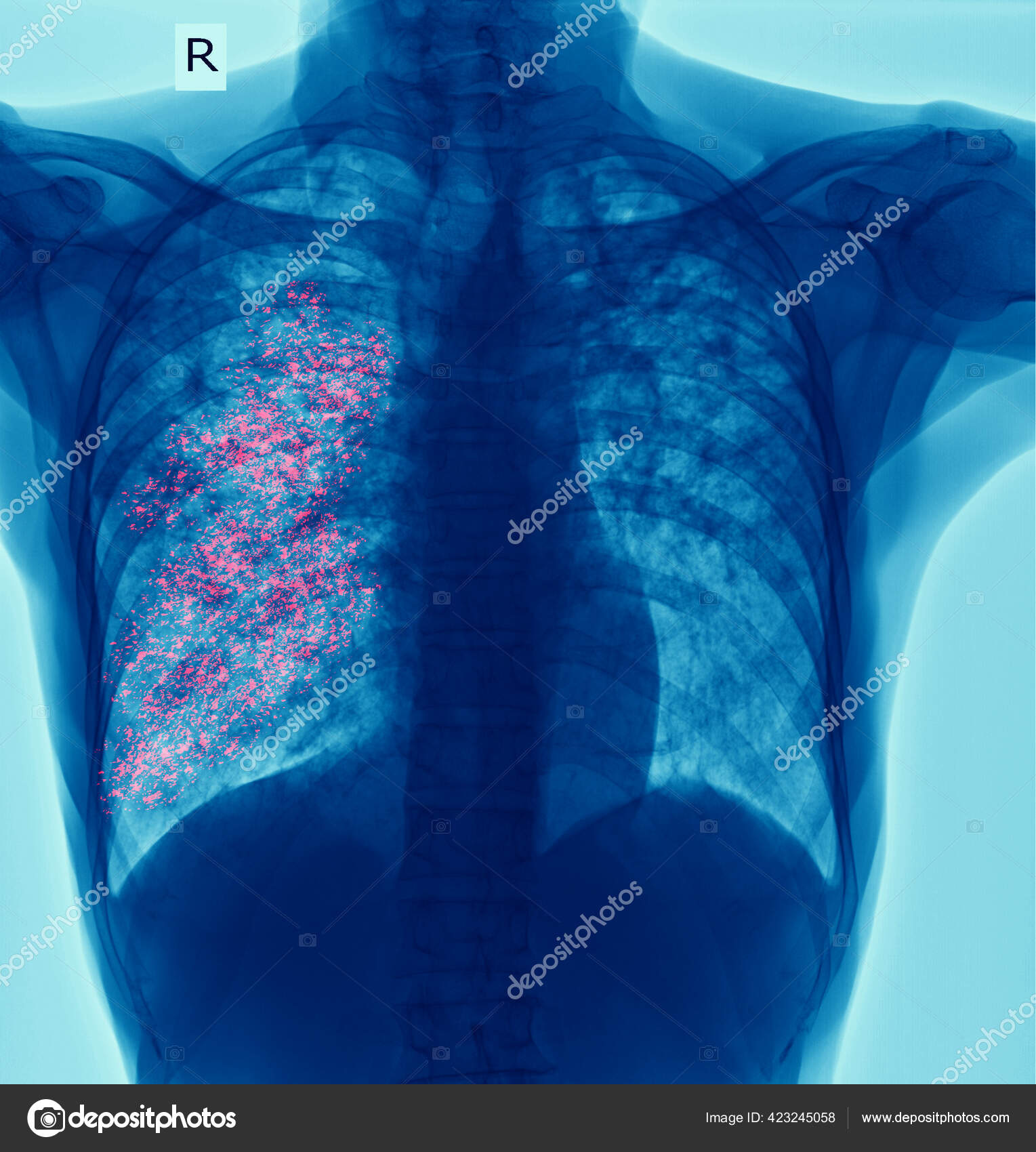 Chest Rau Showing Cavity Right Lung Interstitial Infiltrate Both Lung ...