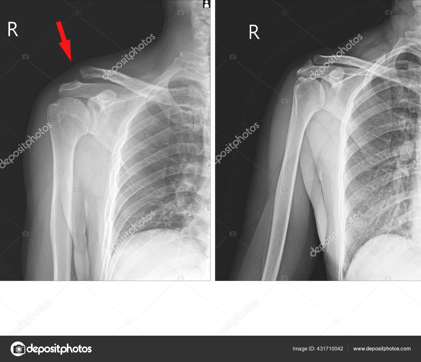 Radiografía Hombro Derecho Subluation Acromioclavicular Joint Injury ...