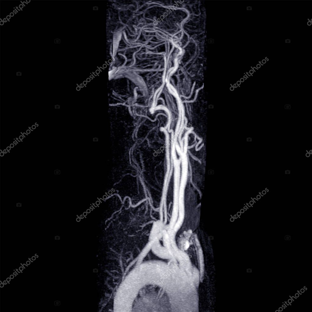 Imagen suave y borrosa, Imagen médica RMN (venografía por resonancia magnética) Cerebro de venas ...