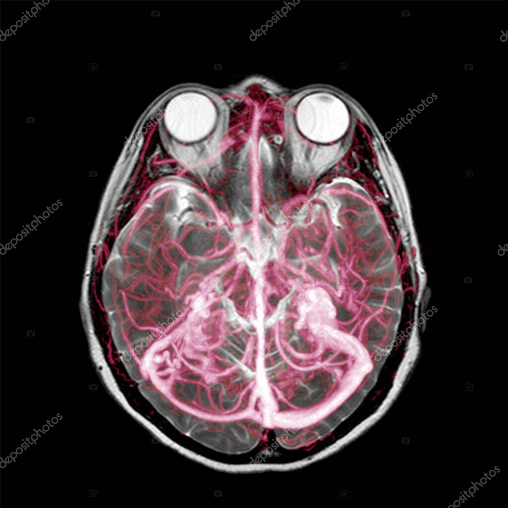 ARM (angiografía por resonancia magnética) del cerebro para el paciente ...