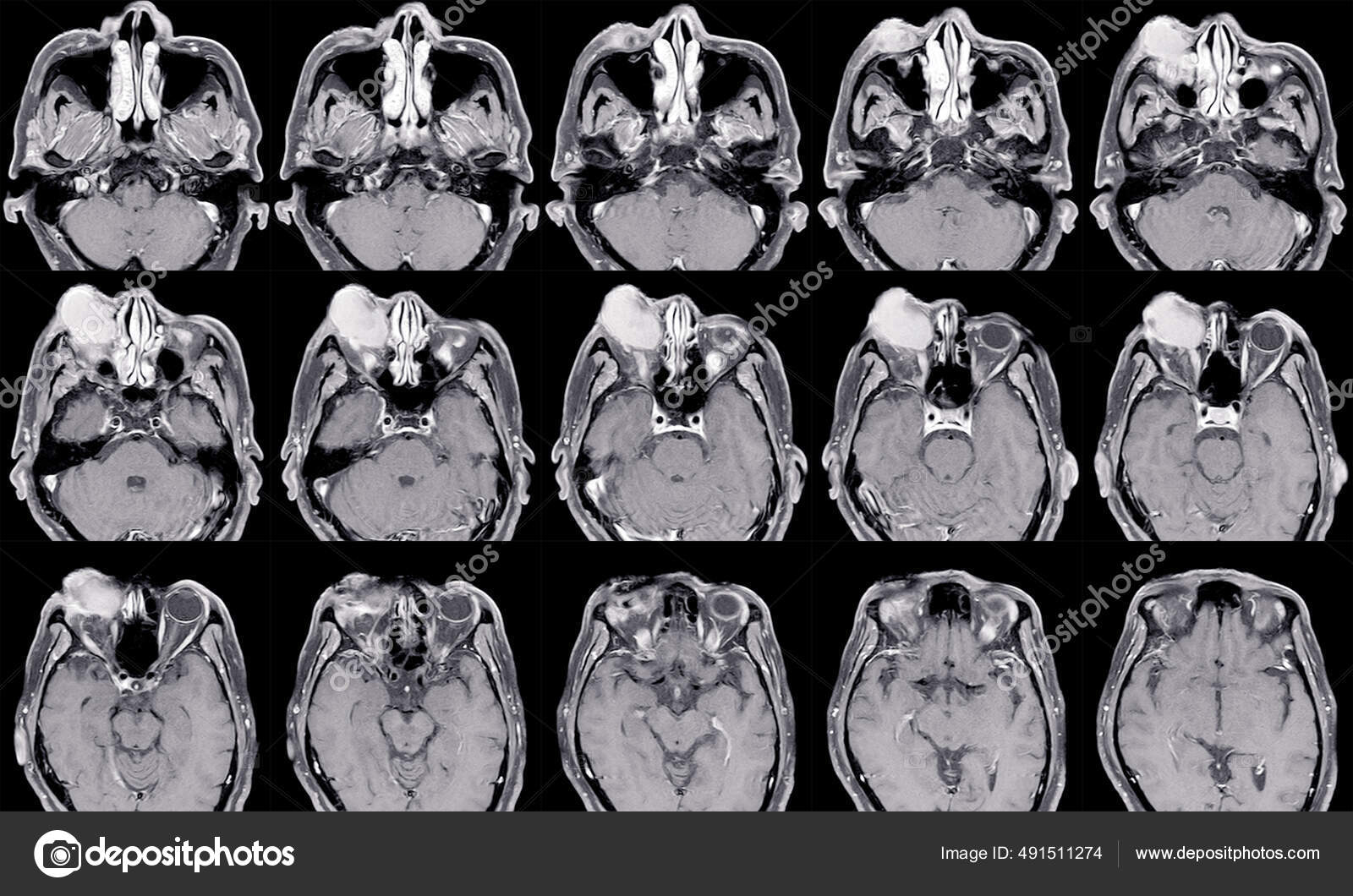 Mri Brain Orbit History Growing Right Orbital Mass Year Orbital — Stock ...