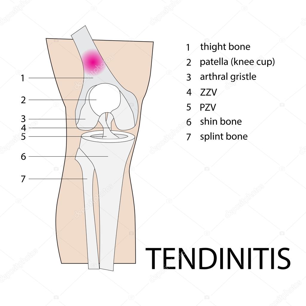 Tendinitis injury Stock Illustration by ©paveu #78438792