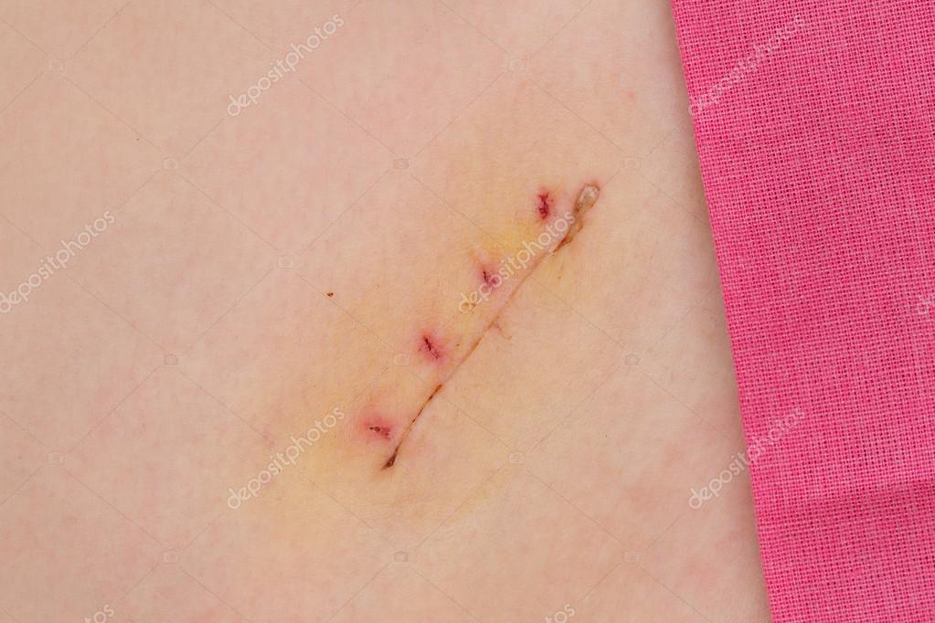 Appendix Removal Scar
