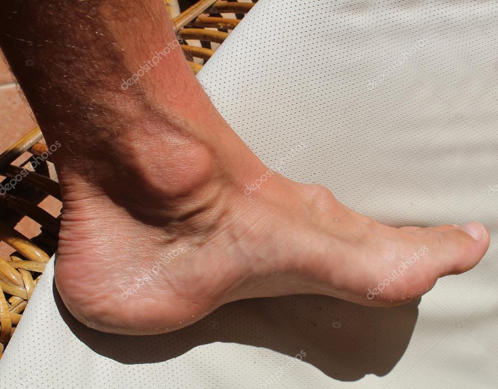Hallux foot — Stock Photo © JackyBrown #65590807