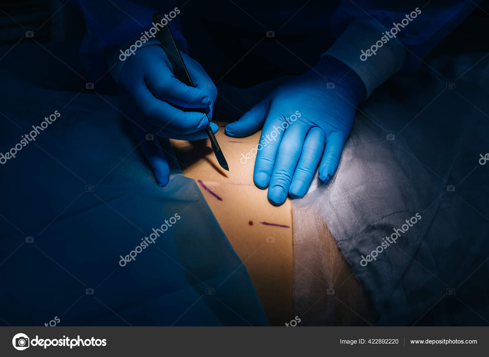 Close Photo Surgeon Hand Hold Scalpel Make Incision Patient Skin ...