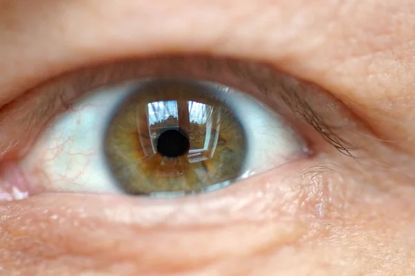 Lenticular cataract Stock Photos, Royalty Free Lenticular cataract ...