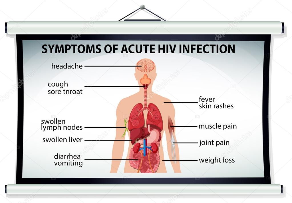 Gráfico que muestra síntomas de infección aguda por VIH Vector de stock #116840106 de ...
