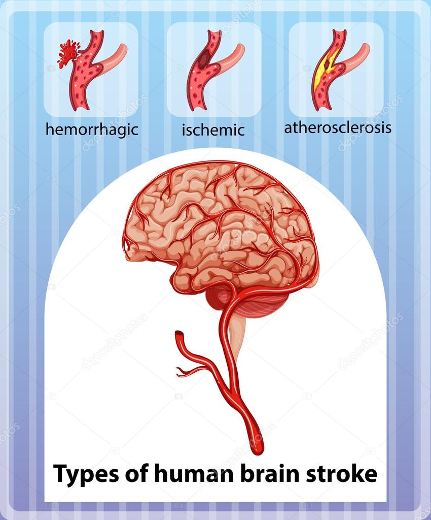 Types of human brain stroke Stock Vector Image by ©interactimages ...
