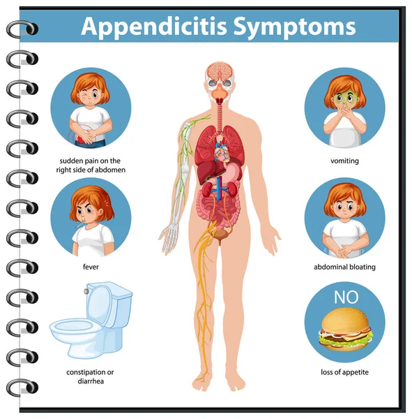 Appendicitis infographic Vector Art Stock Images | Depositphotos