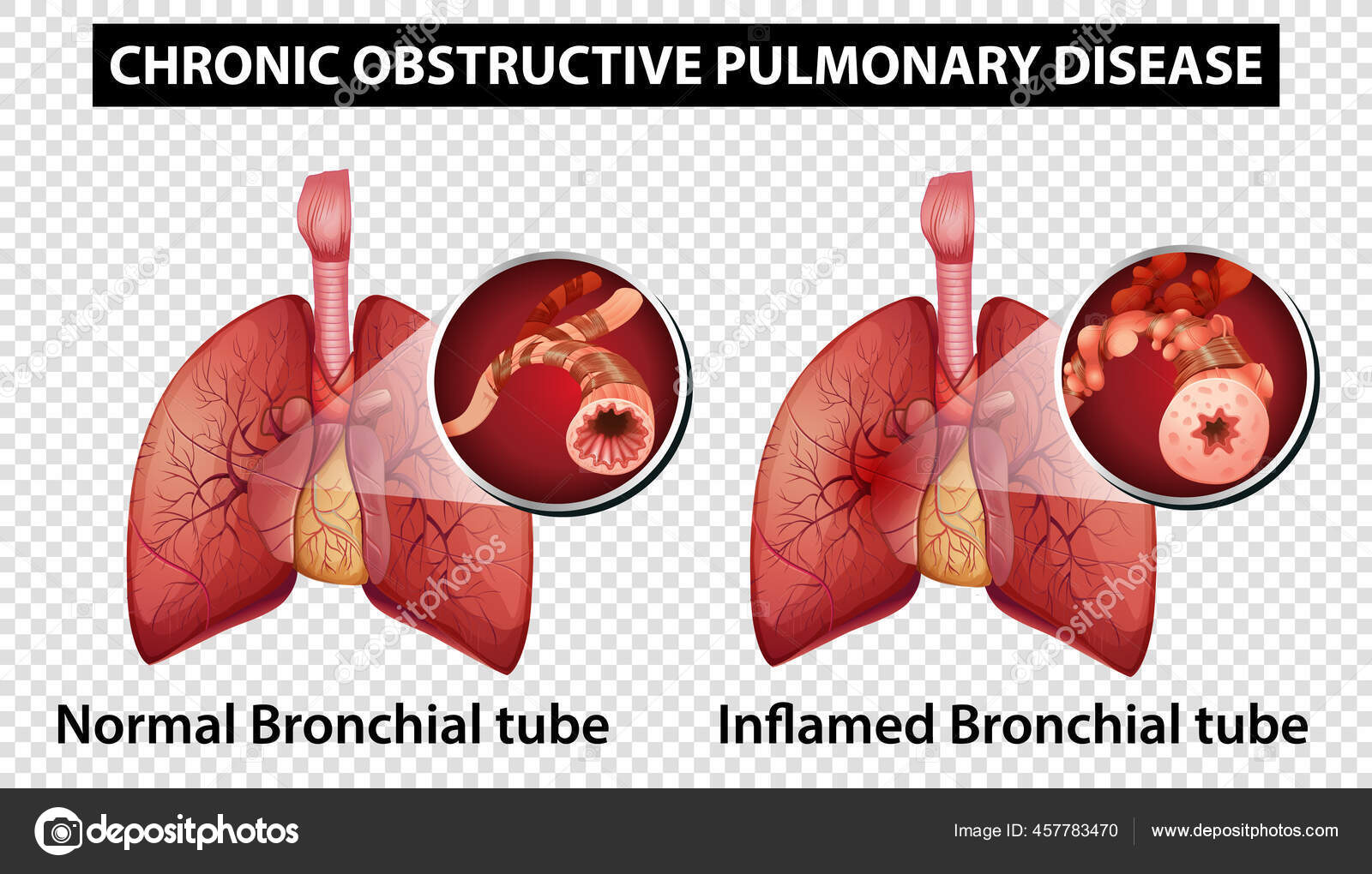 Diagram Showing Chronic Obstructive Pulmonary Disease Transparent ...