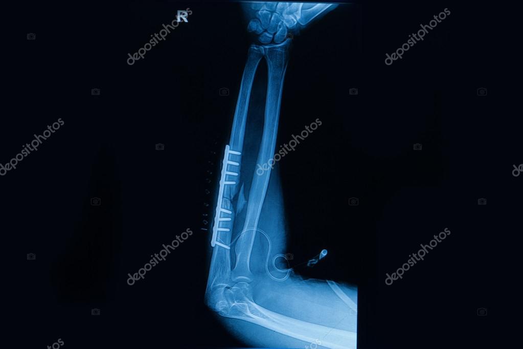 Collection of human x-rays showing fracture of radius bone Stock Photo ...