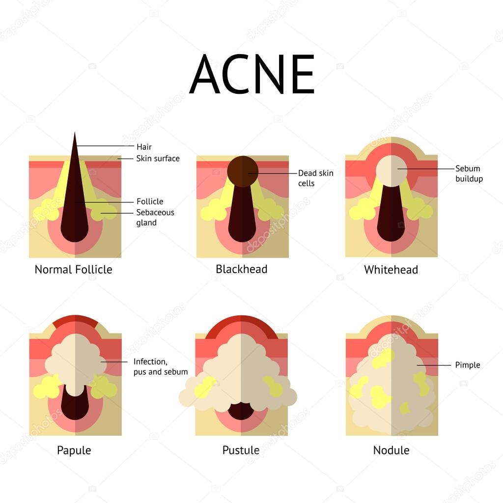 Tipos de espinhas de acne. Pele saudável, Whiteheads e Blackheads ...