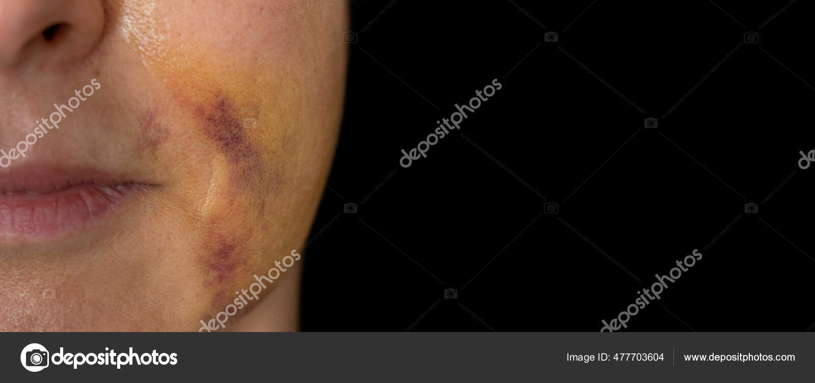 Unrecognizable woman face with bruises against black background — Stock ...