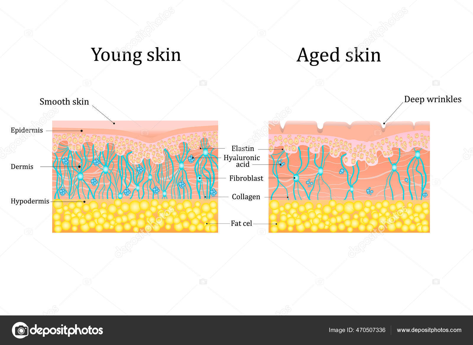 Vector illustration of age-related changes in the skin. Comparison of ...
