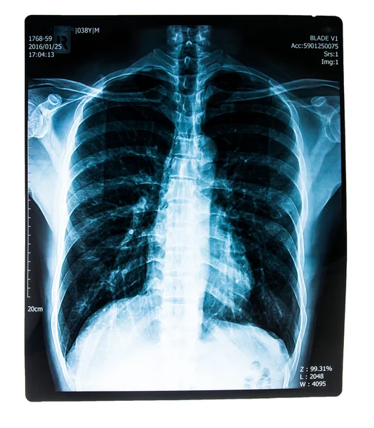 Picture: a picc line | X-ray of correct PICC line insertion — Stock ...