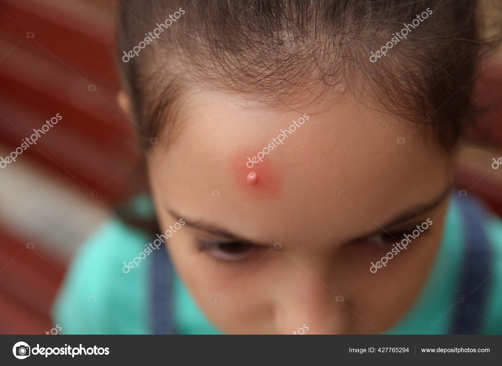 Mosquito Bites On Forehead