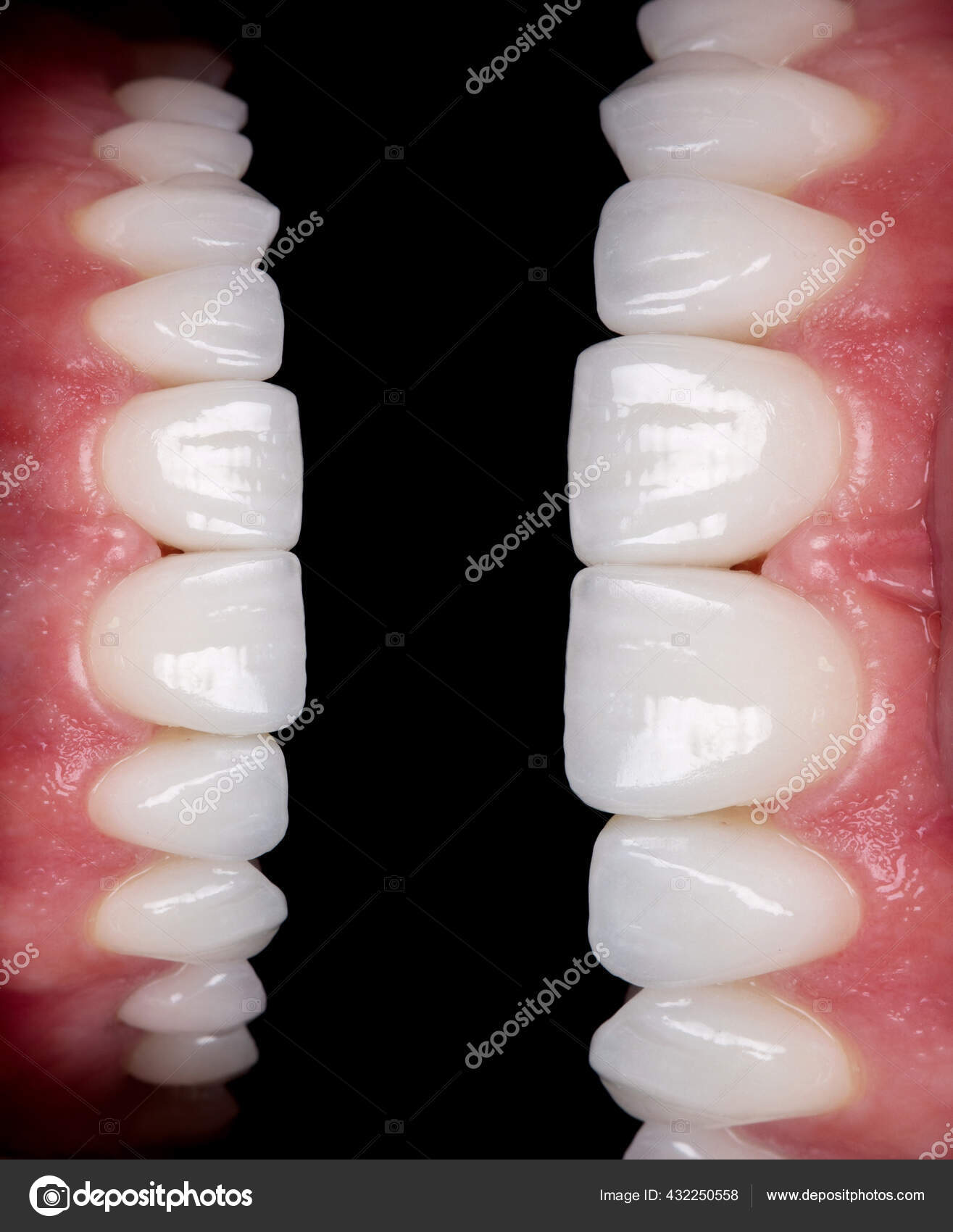 Beautiful Upper Teeth Ceramic Press Ceramic Crowns Veneers Dental Stone ...