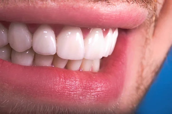 Veneer teeth Images - Search Images on Everypixel