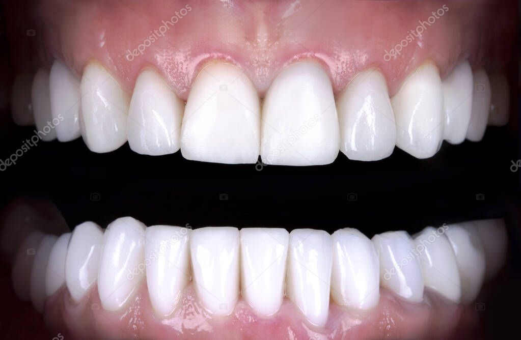 Perfect smile whitening veneers bleach of zircon arch ceramic prothesis ...