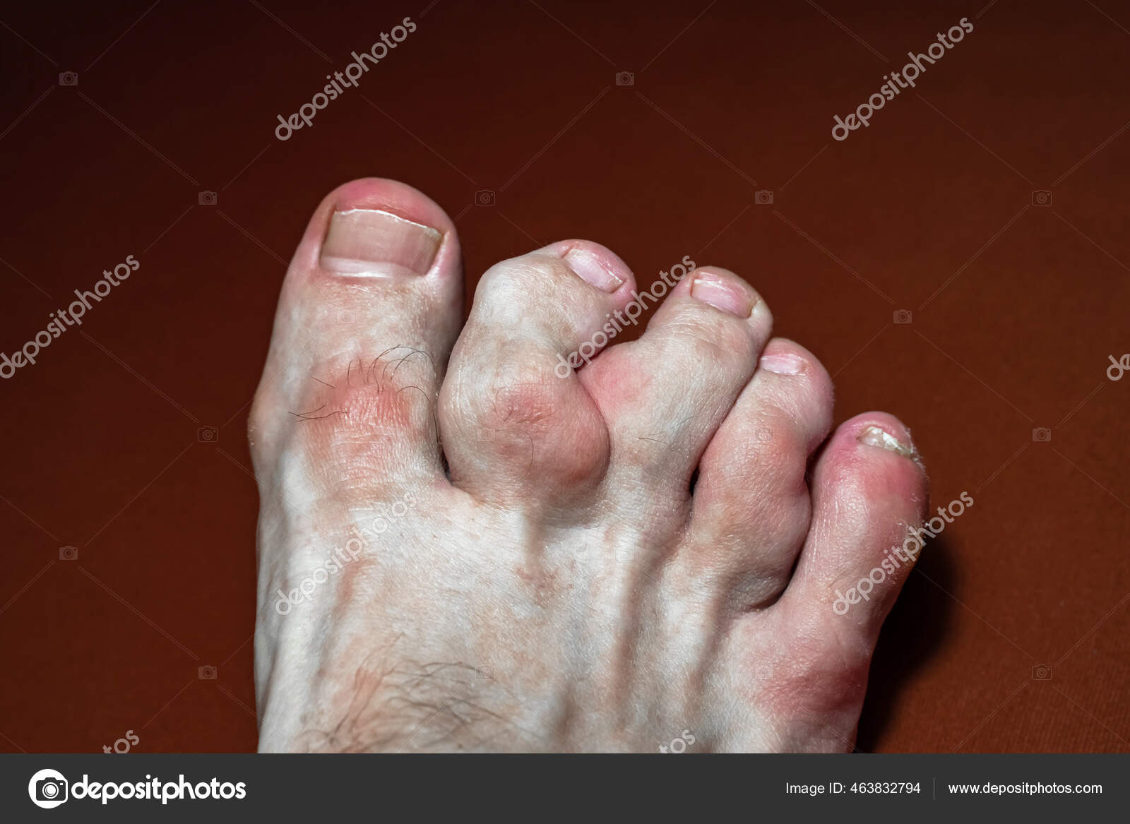 Smaller Gout In Toes