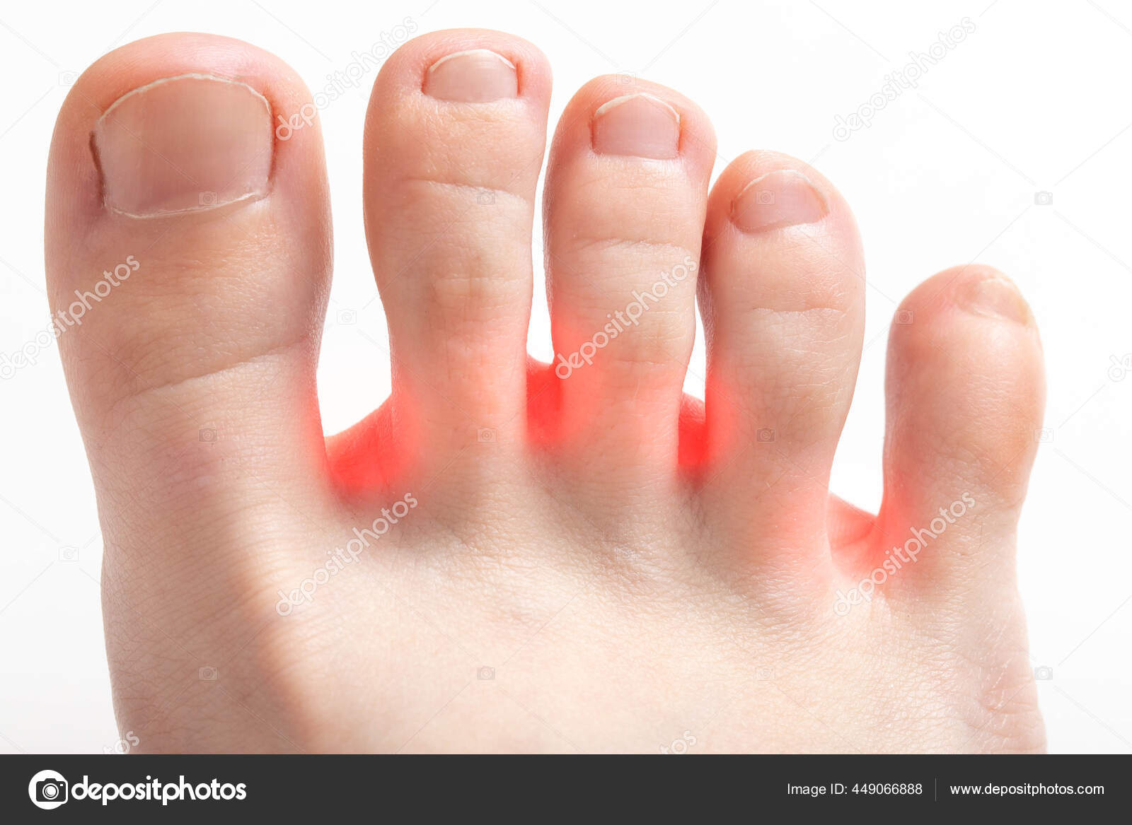 Redness Toes Onychomycosis Macro Foot Fungus Disease Treatment Concept ...
