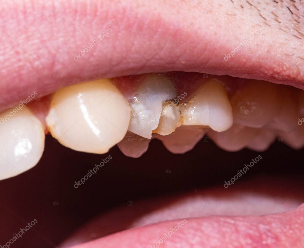 Un diente negro muerto en el que se desprende un trozo de esmalte ...