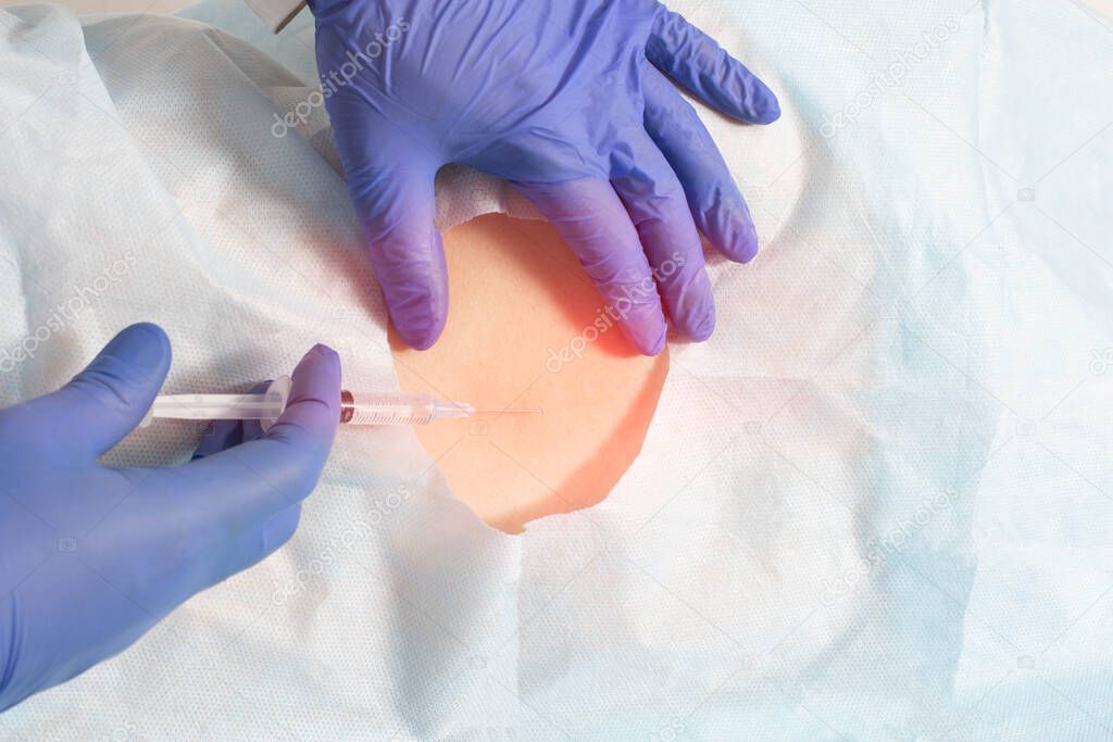 El médico realiza un bloqueo epidural en un paciente para aliviar el ...