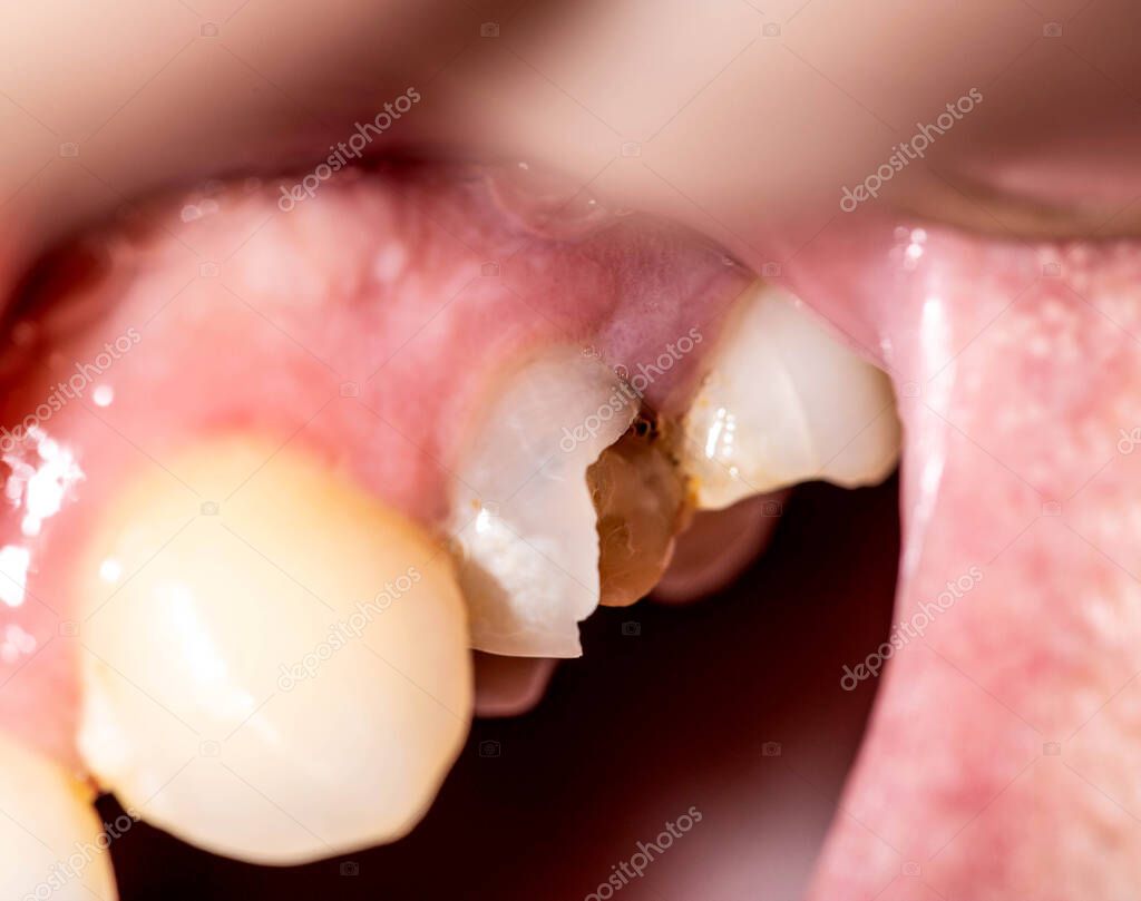 Un diente negro muerto en el que se desprende un trozo de esmalte ...
