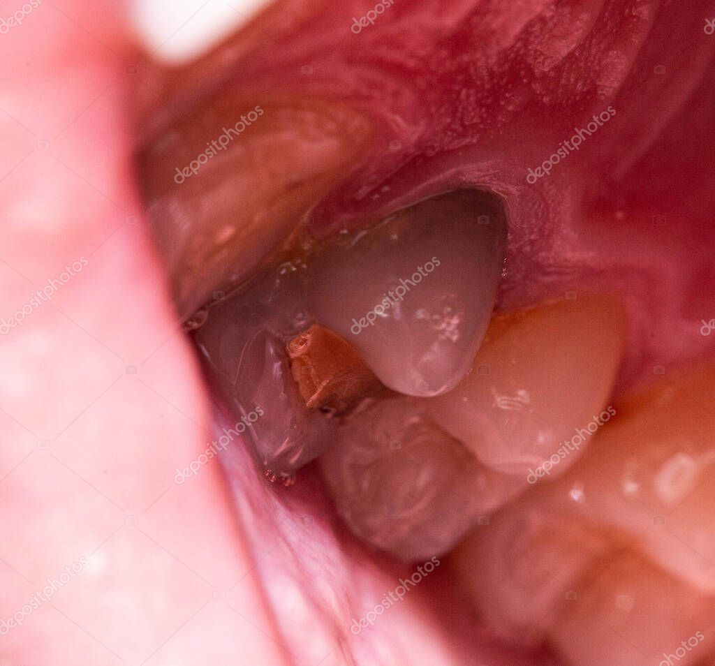 Trozo de un diente de pulpa muerto. Restauración de un diente dañado en ...