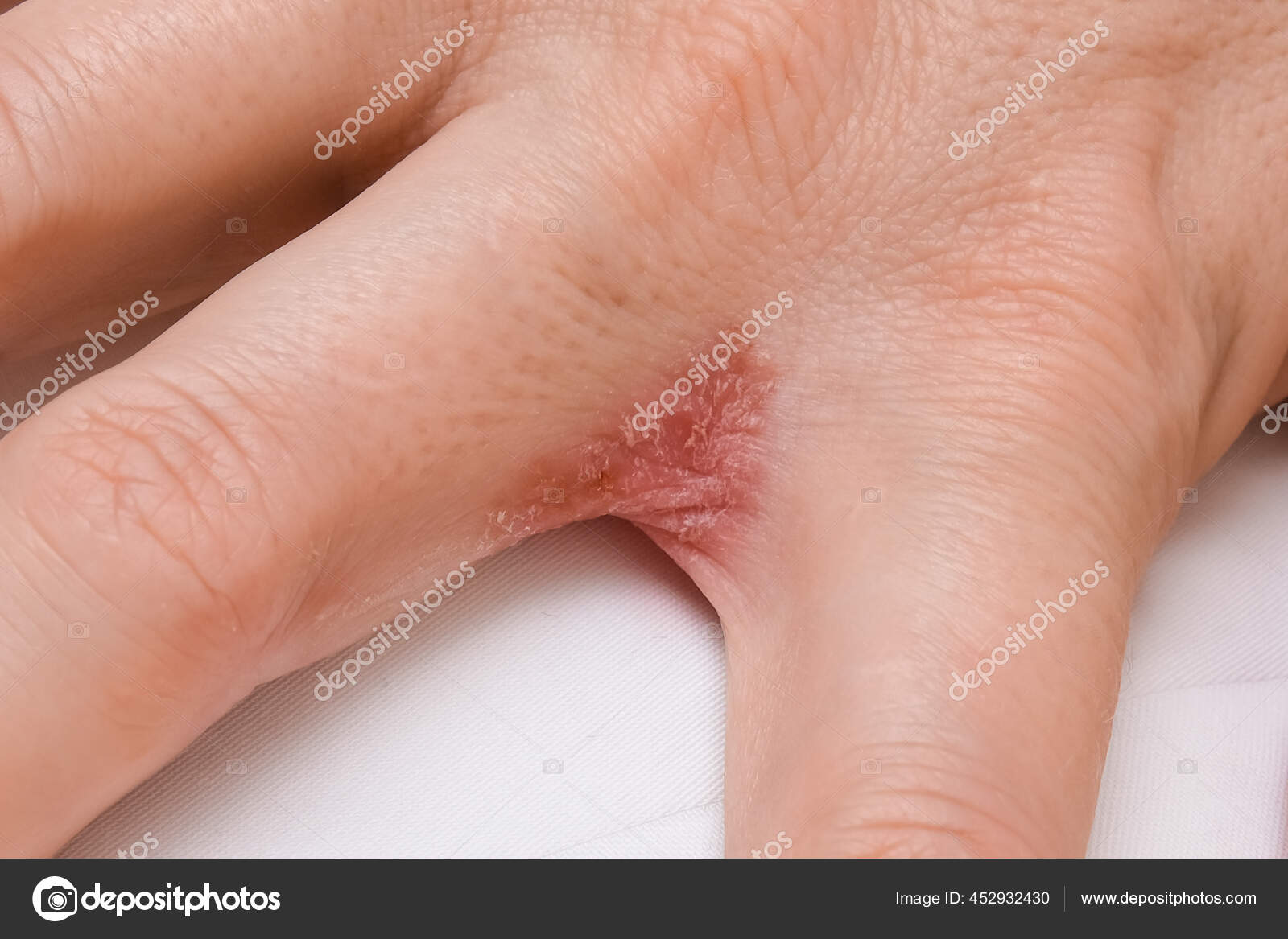 Dyshidrotic Eczema Finger