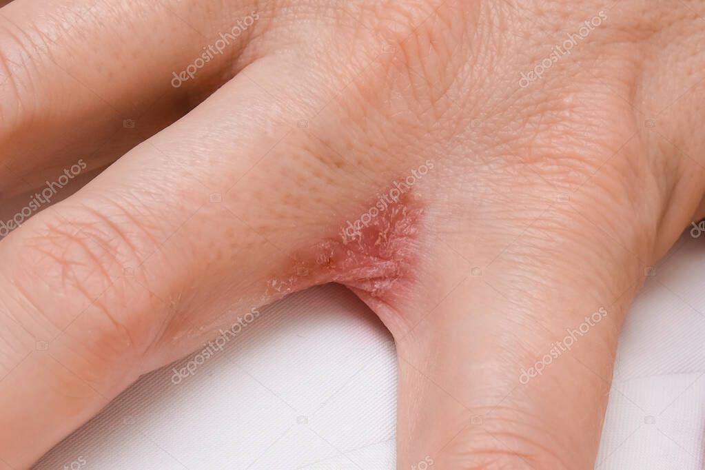 Mano con dermatitis interdigital, eccema disshidrótico a mano de cerca 2023
