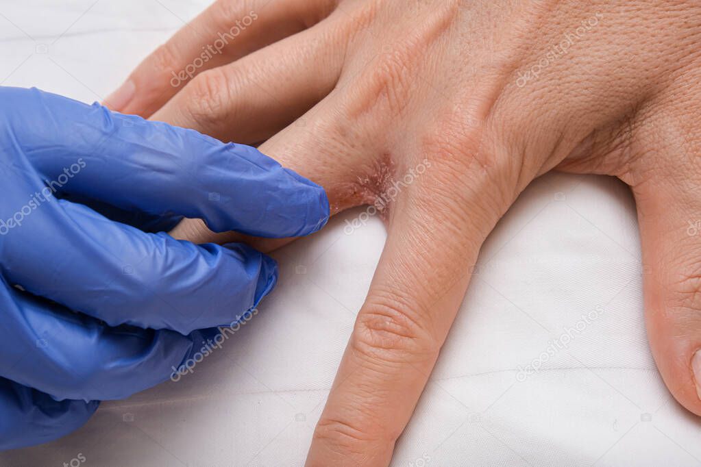 Un dermatólogo médico examina a los pacientes de la mano con dermatitis ...