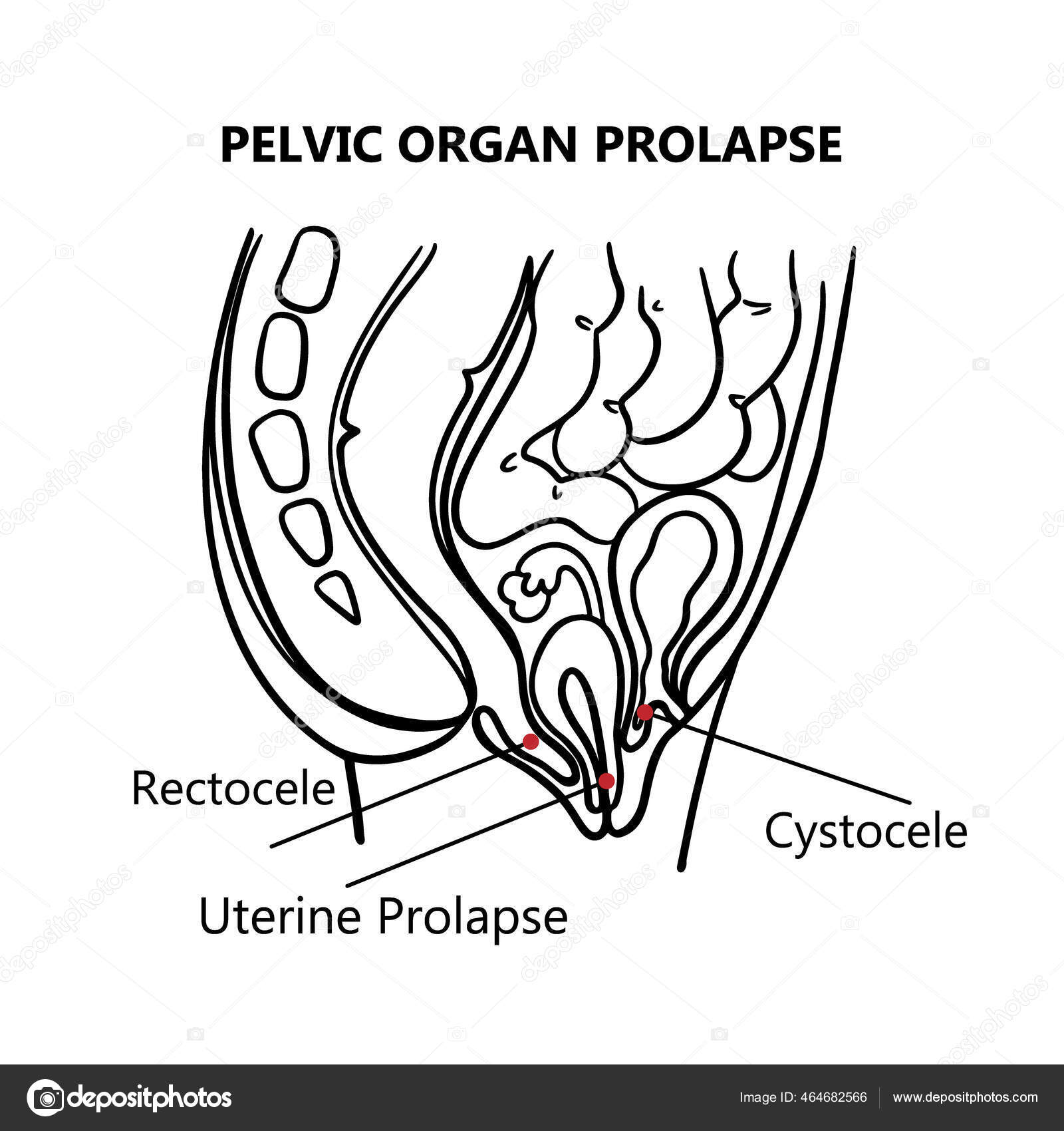 Pelvic Organ Prolapse Monochrome Women General Diagram Explanatory Text
