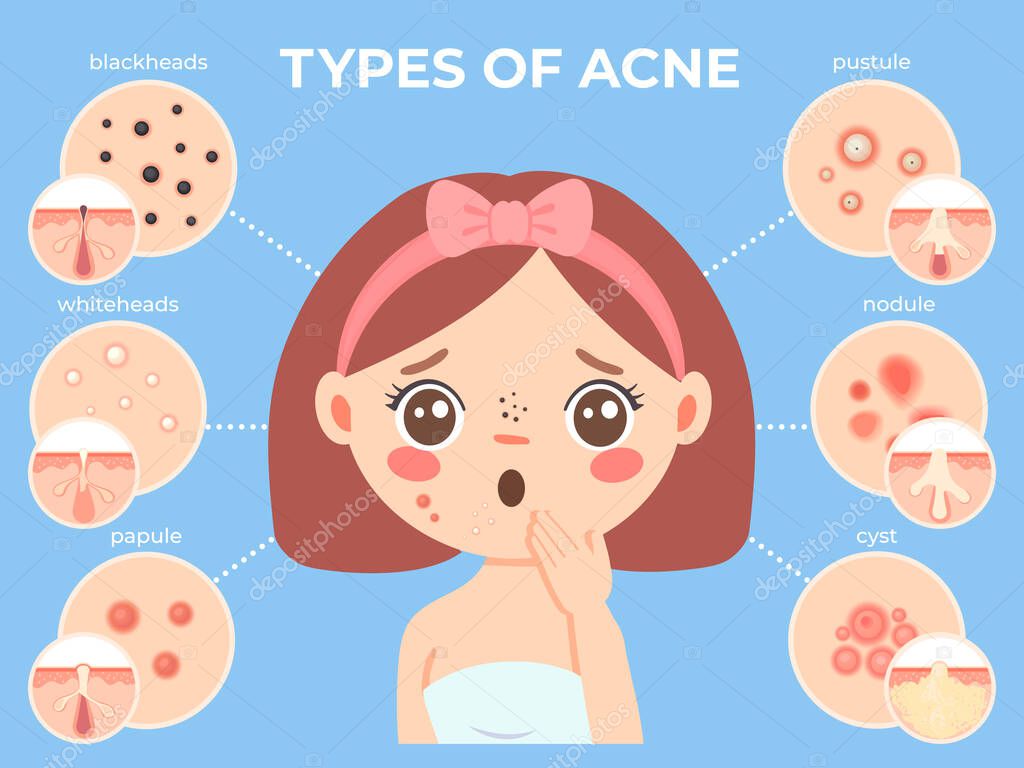 Girl with acne. Young unhappy female face with skin problems and pimple ...