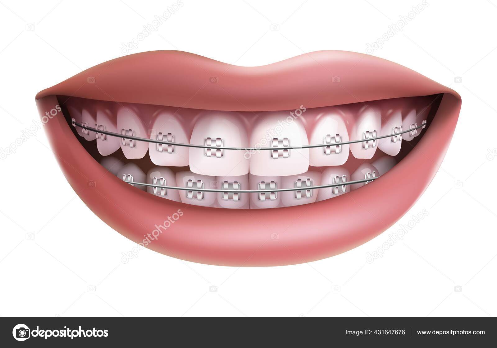 Smile Teeth Braces Clip Art