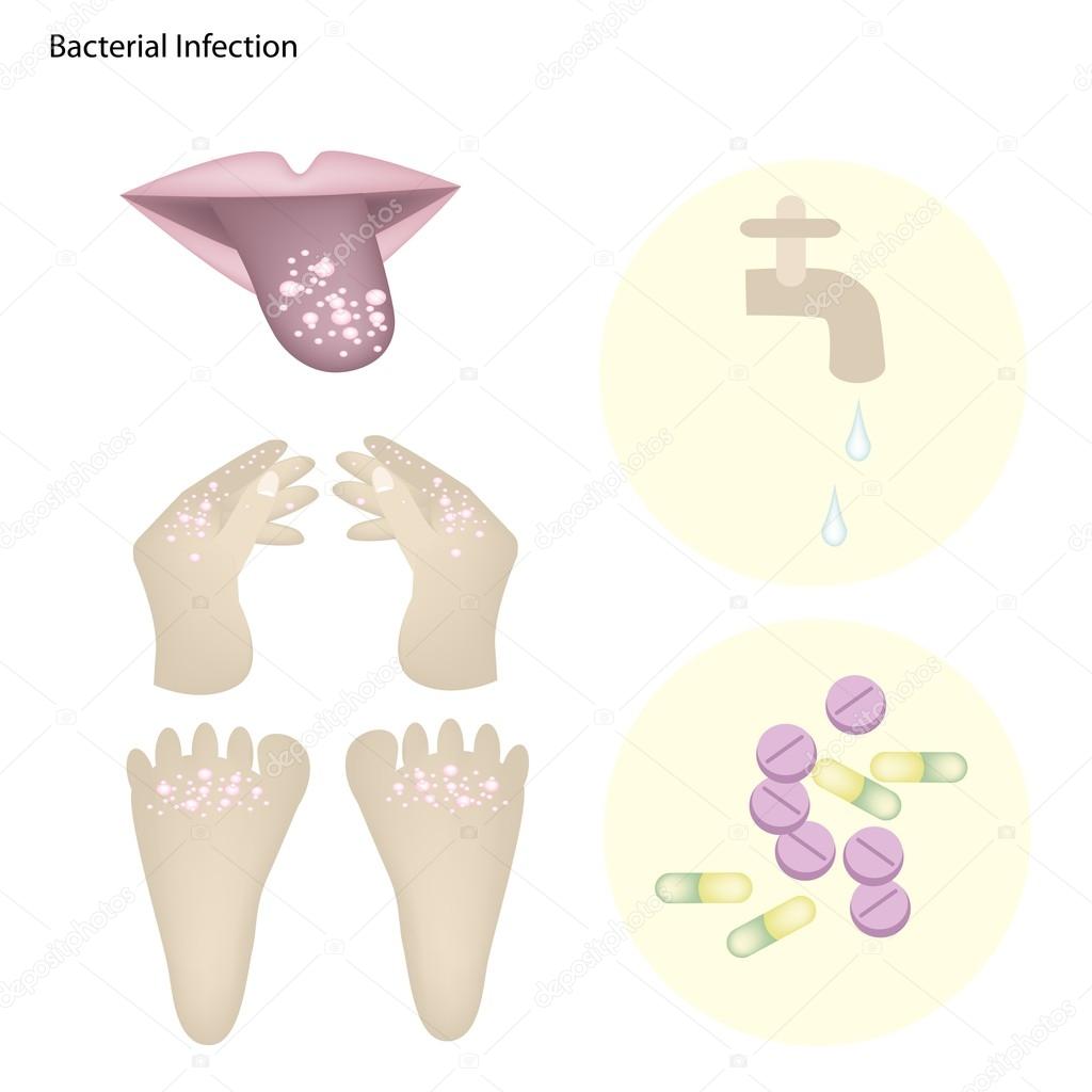 Bacterial Infection with Disease Prevention and Treatment Stock Vector ...