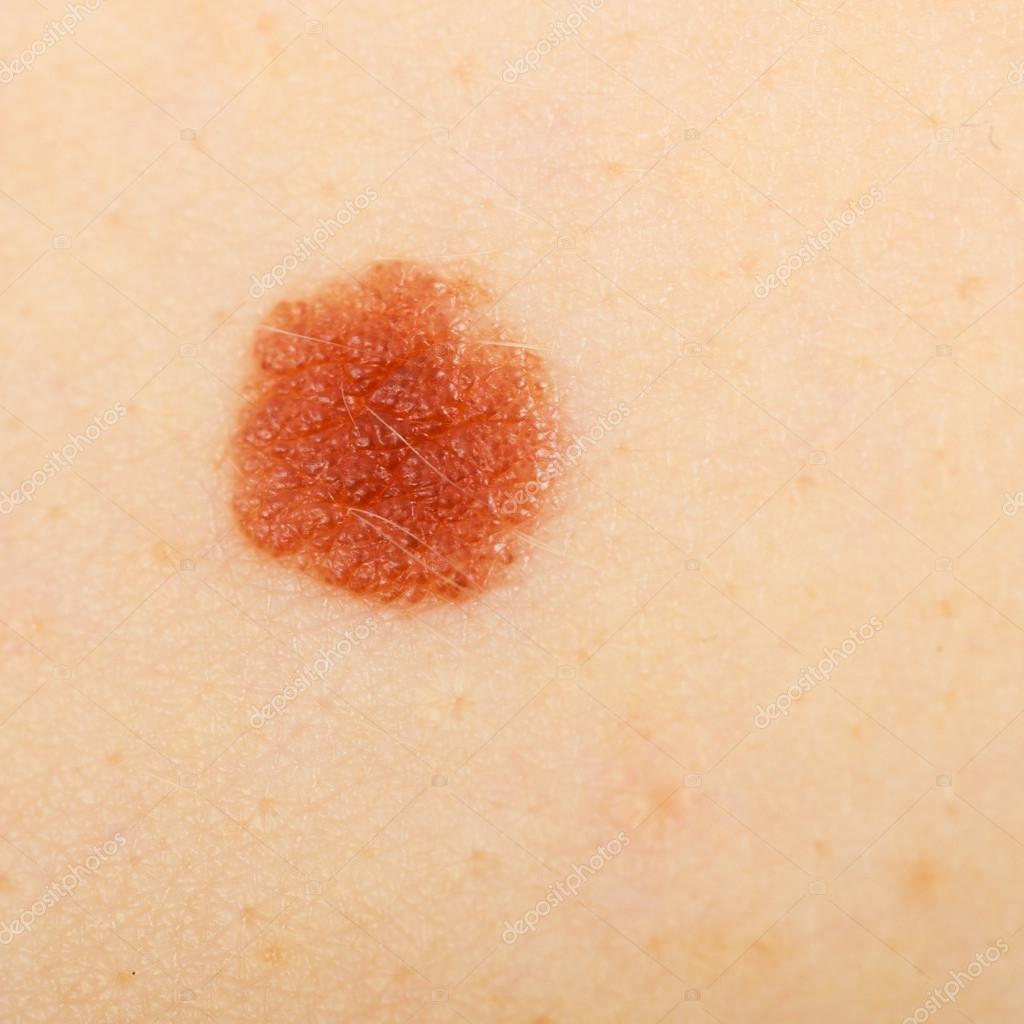 Closeup brown mole on caucasian woman skin. — Stock Photo © Voyagerix ...