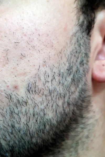 Rash on beard Stock Photos, Royalty Free Rash on beard Images ...