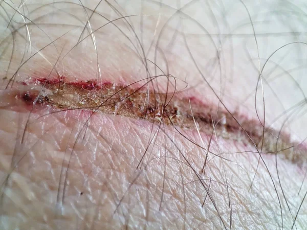 Ingrown hair Stock Photos, Royalty Free Ingrown hair Images | Depositphotos