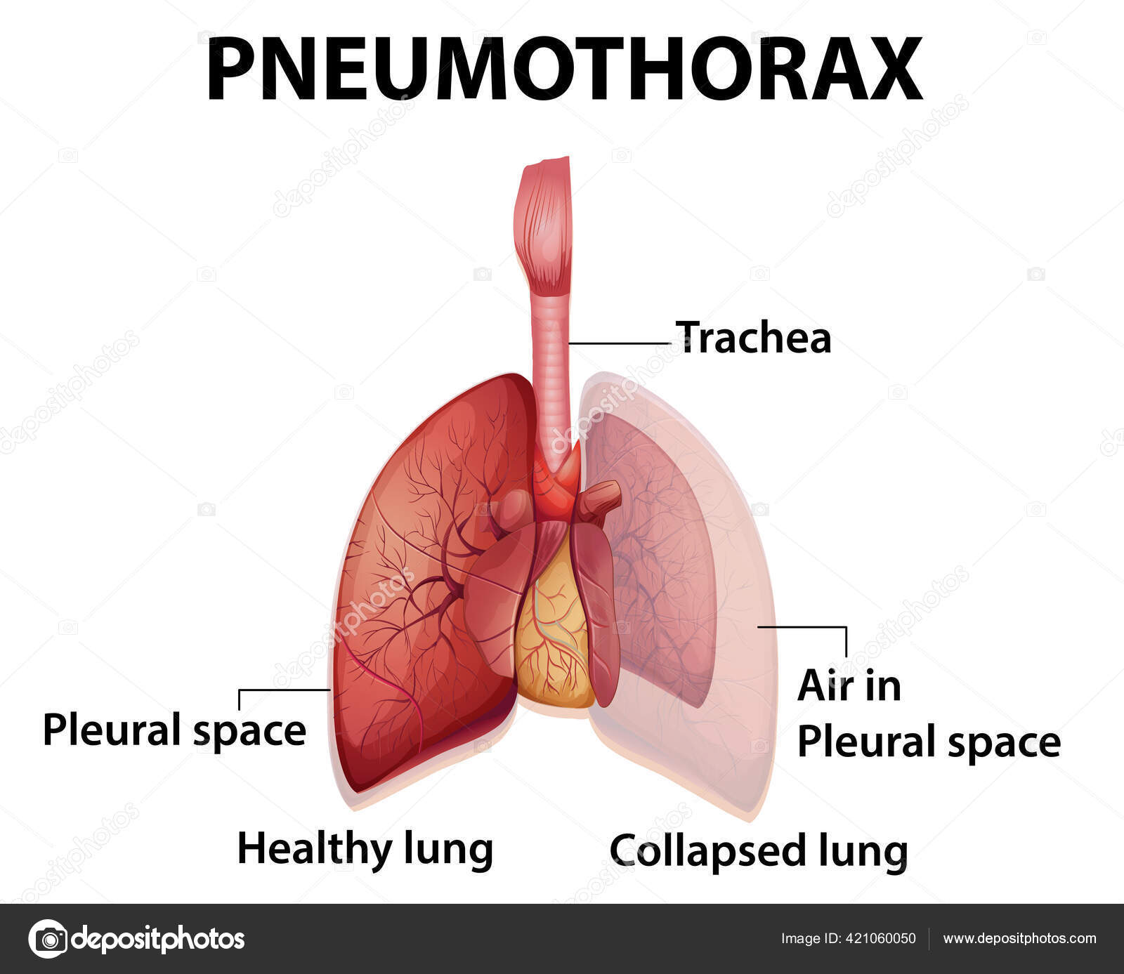 Hemopneumothorax Diagram