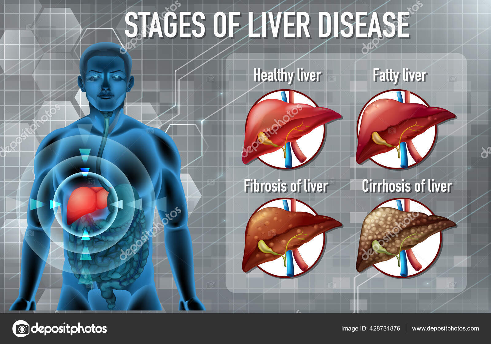 Etapas Ilustração Doença Hepática imagem vetorial de © blueringmedia ...