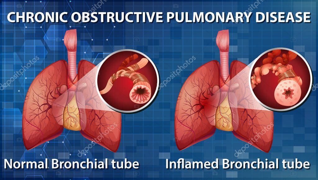 Enfermedad pulmonar obstructiva crónica ilustración 2024