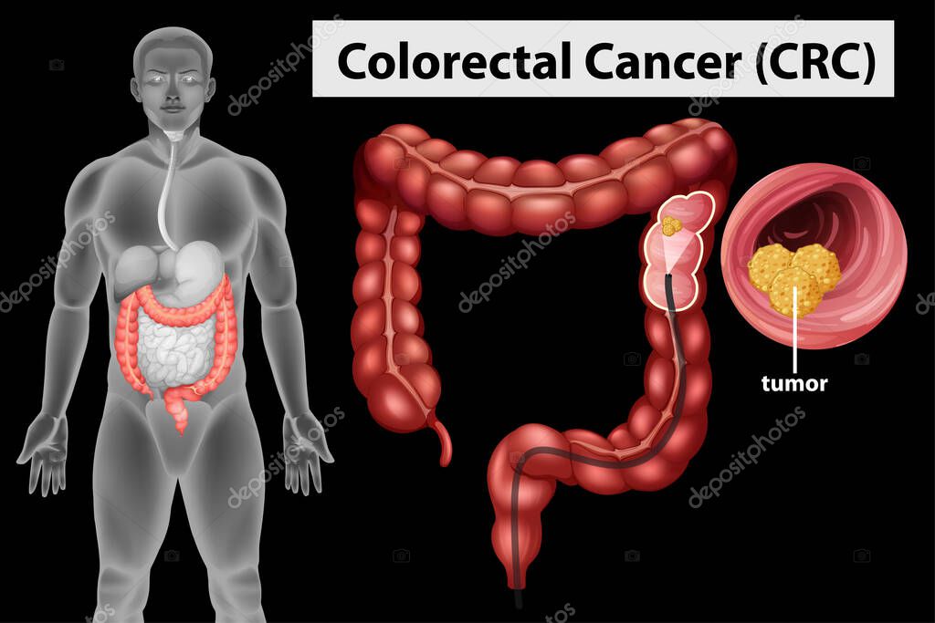 Infografía del cáncer colorrectal (CCR) para ilustración educativa 2023