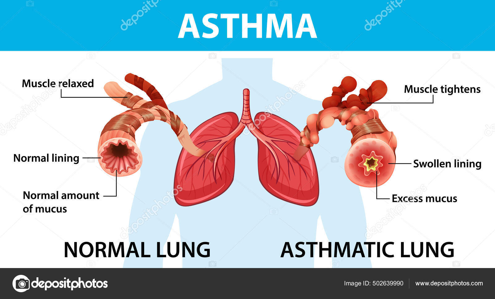 Diagrama Del Asma Con Ilustración Normal Pulmón Pulmón Asmático vector ...