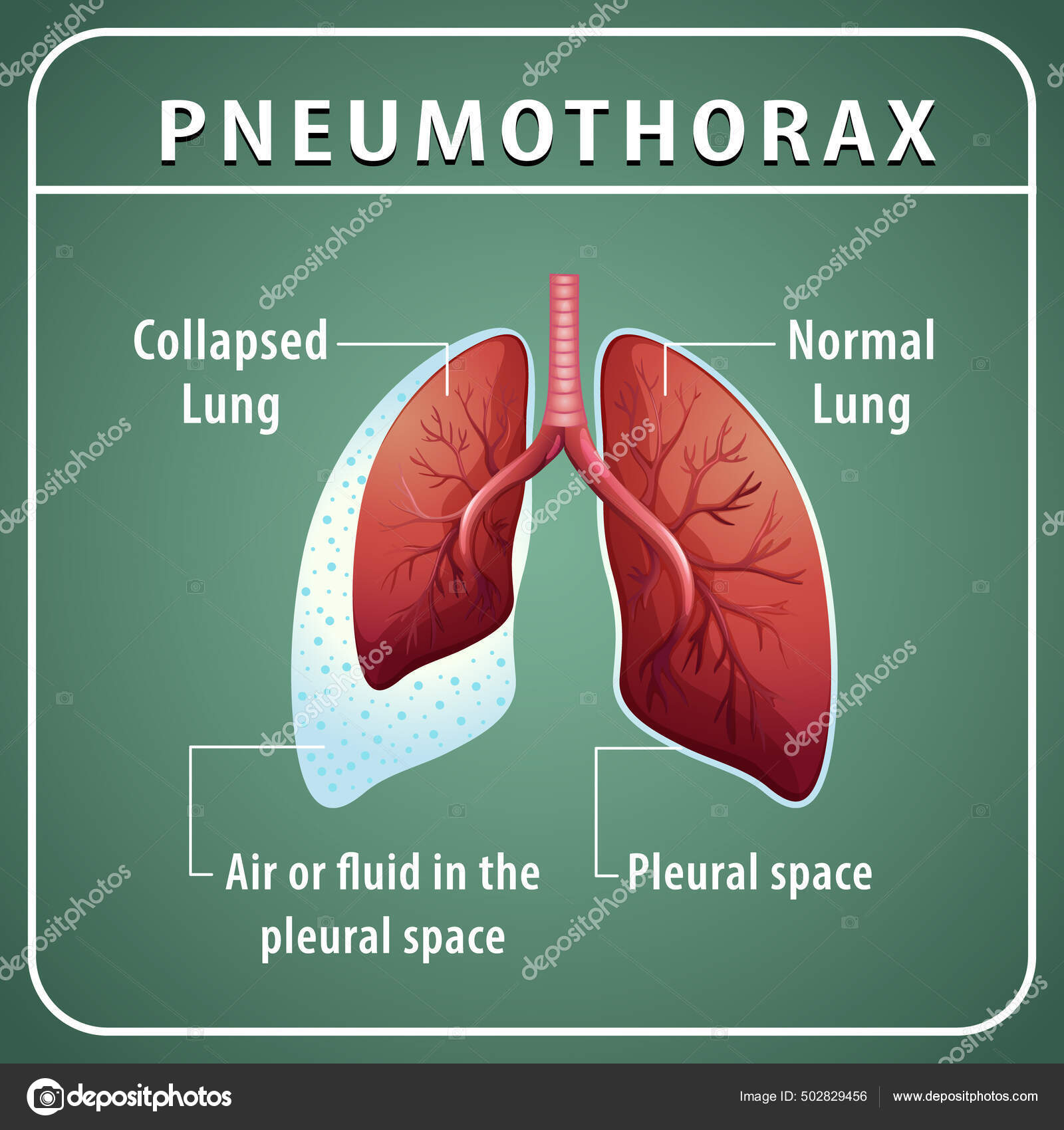Pneumothorax Diagram Collapsed Lung Normal Lung Illustration Stock ...