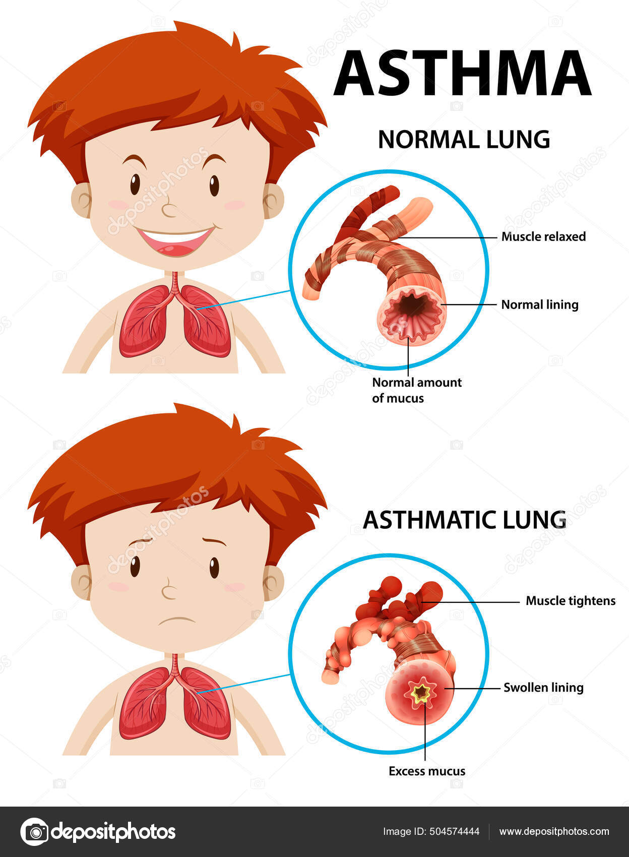 Diagram Asma Dengan Ilustrasi Paru Paru Normal Dan Paru Paru Vektor ...