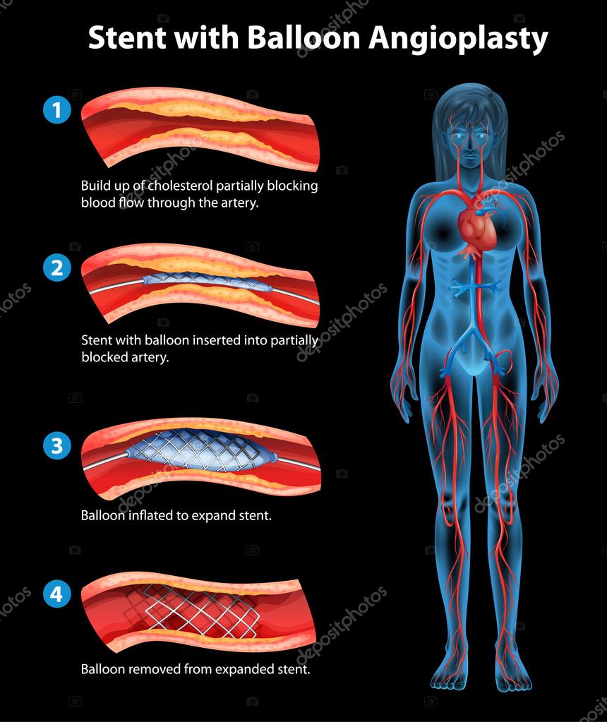 Stent angioplasty procedure Stock Vector Image by ©blueringmedia #58926313