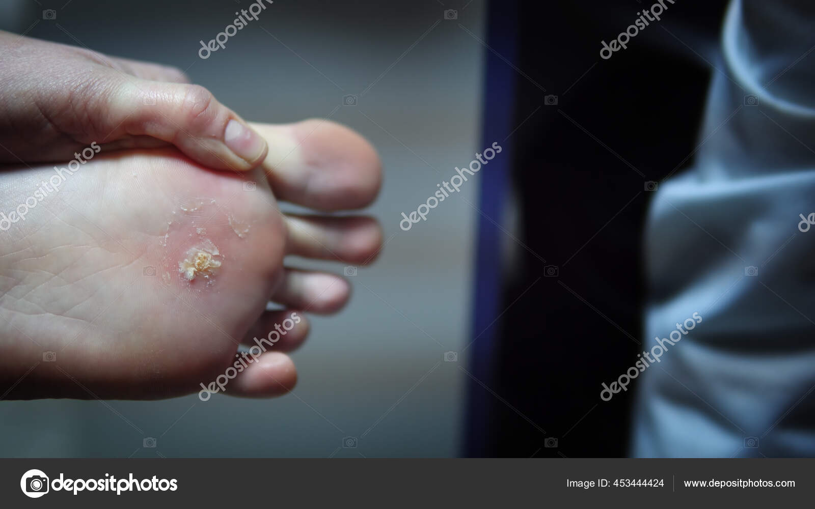 Infected Foot Bacterical Uclers Skin Allergic Desease — Stock Photo ...