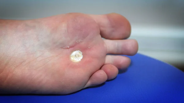 Infected Foot Bacterical Uclers Skin Allergic Desease — Stock Photo ...