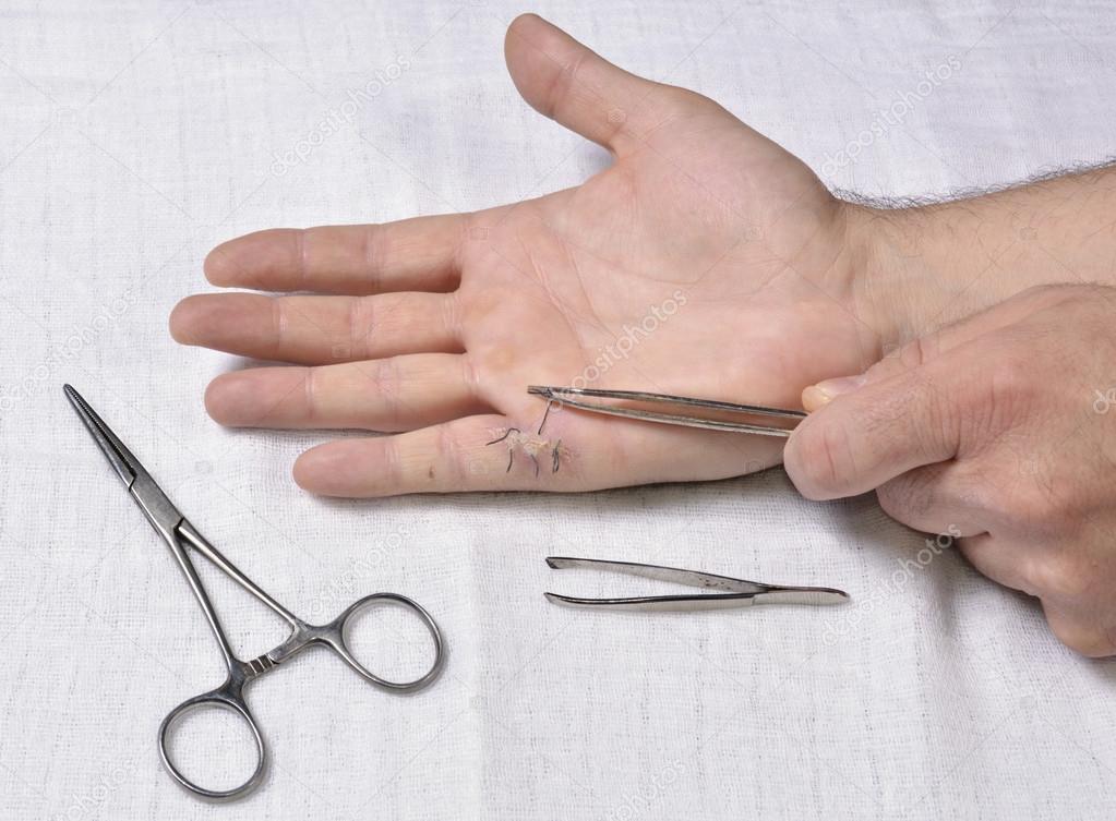 Removing medical thread from wound — Stock Photo © Vuk.Varuna #60725923
